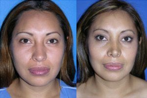 Cirugía de Cachetes - Luisa Plata