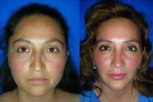 Cirugía de Cachetes - Luisa Plata