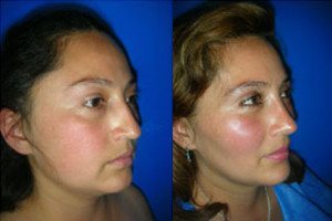 Cirugía de Cachetes - Luisa Plata